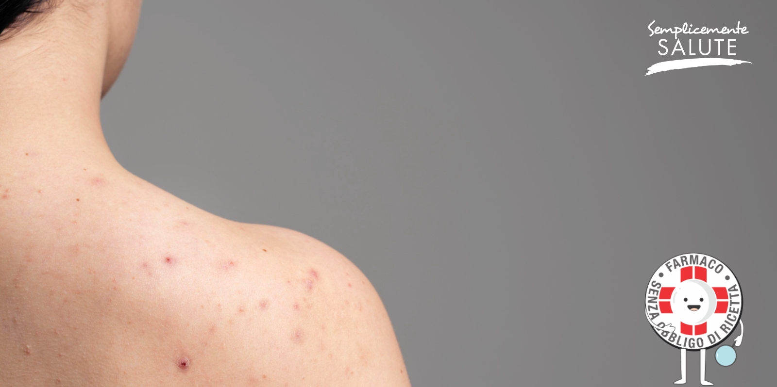 Brufoli su schiena e spalle, come eliminarli - Semplicemente Salute